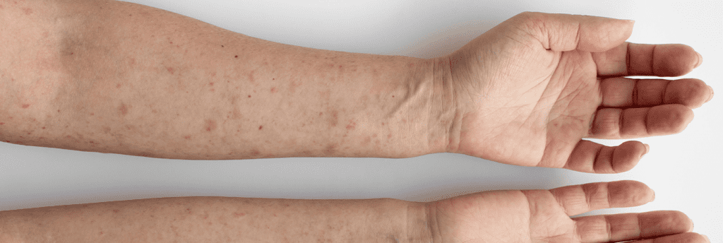 Varíola do Macaco e Odontologia: o que se sabe até agora